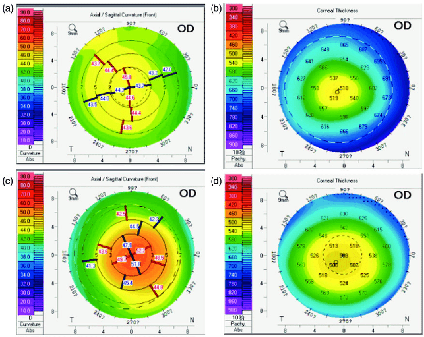 التصوير الطبقي للقرنية Corneal Topography – بوابة التثقيف الصحي